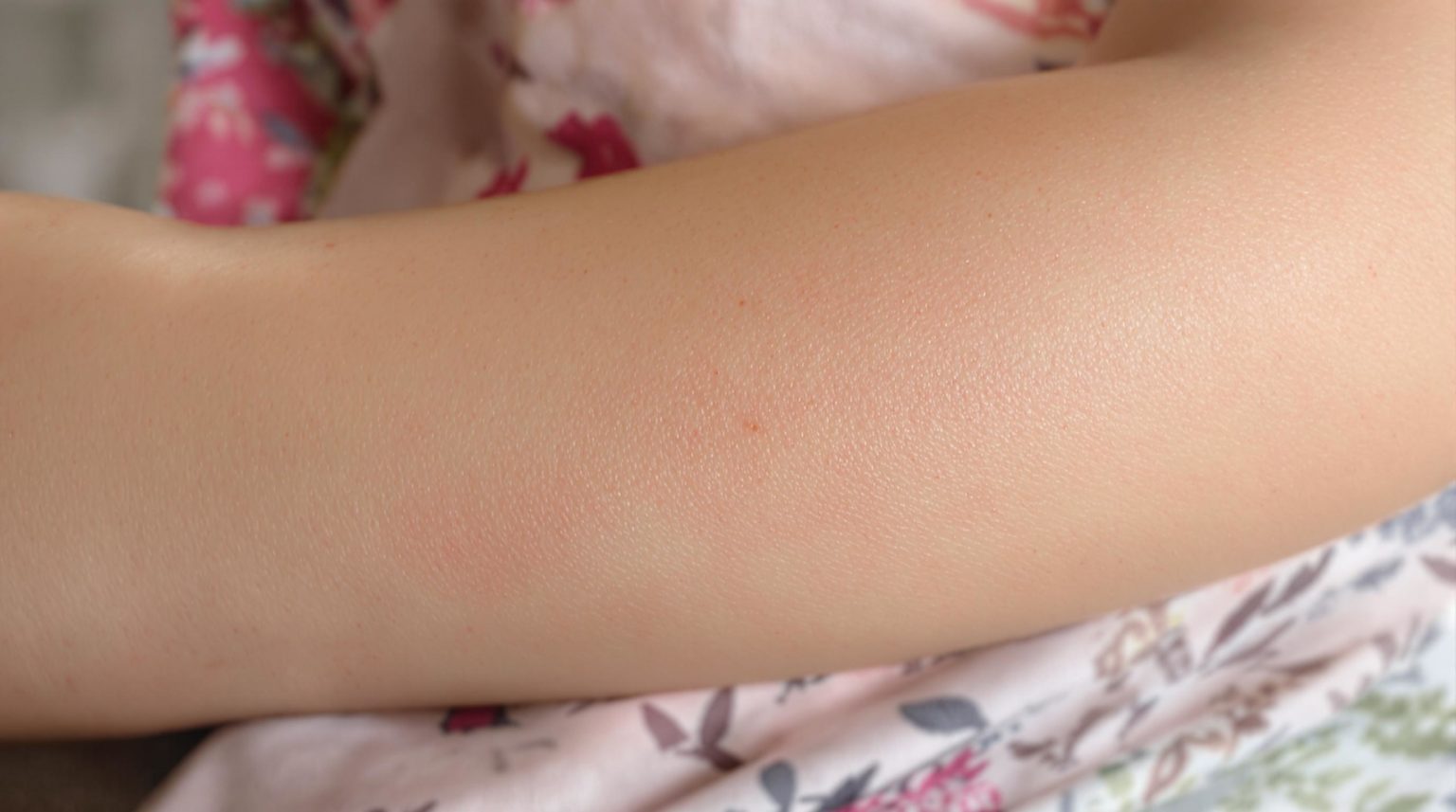 Symptômes gale : démangeaisons et lésions cutanées - Dr Pierre Esposito ...